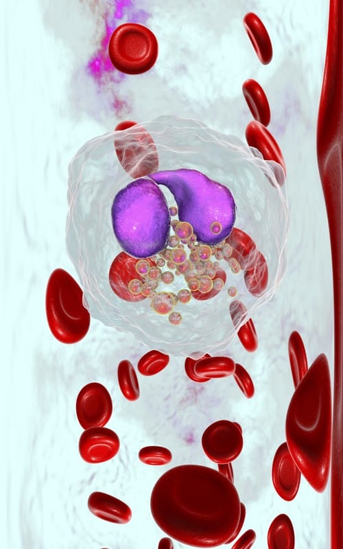 Innovative Therapy for Relapsed Multiple Myeloma - Expert Insights