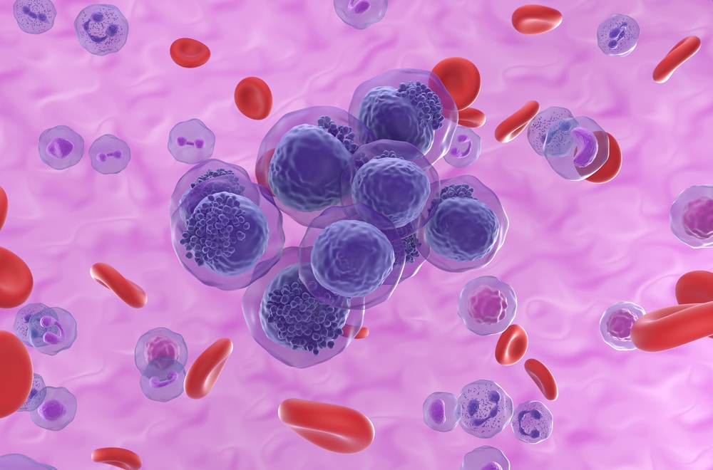 Innovative Therapy for Relapsed Multiple Myeloma - Expert Insights